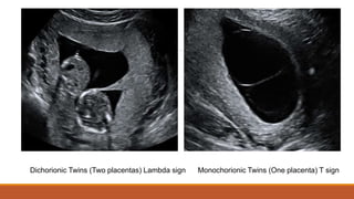 Multifetal pregnancy (Twins Pregnancy) | PPTX