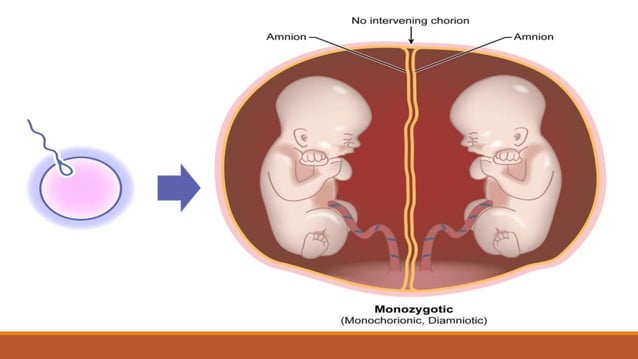 Multifetal pregnancy (Twins Pregnancy) | PPTX