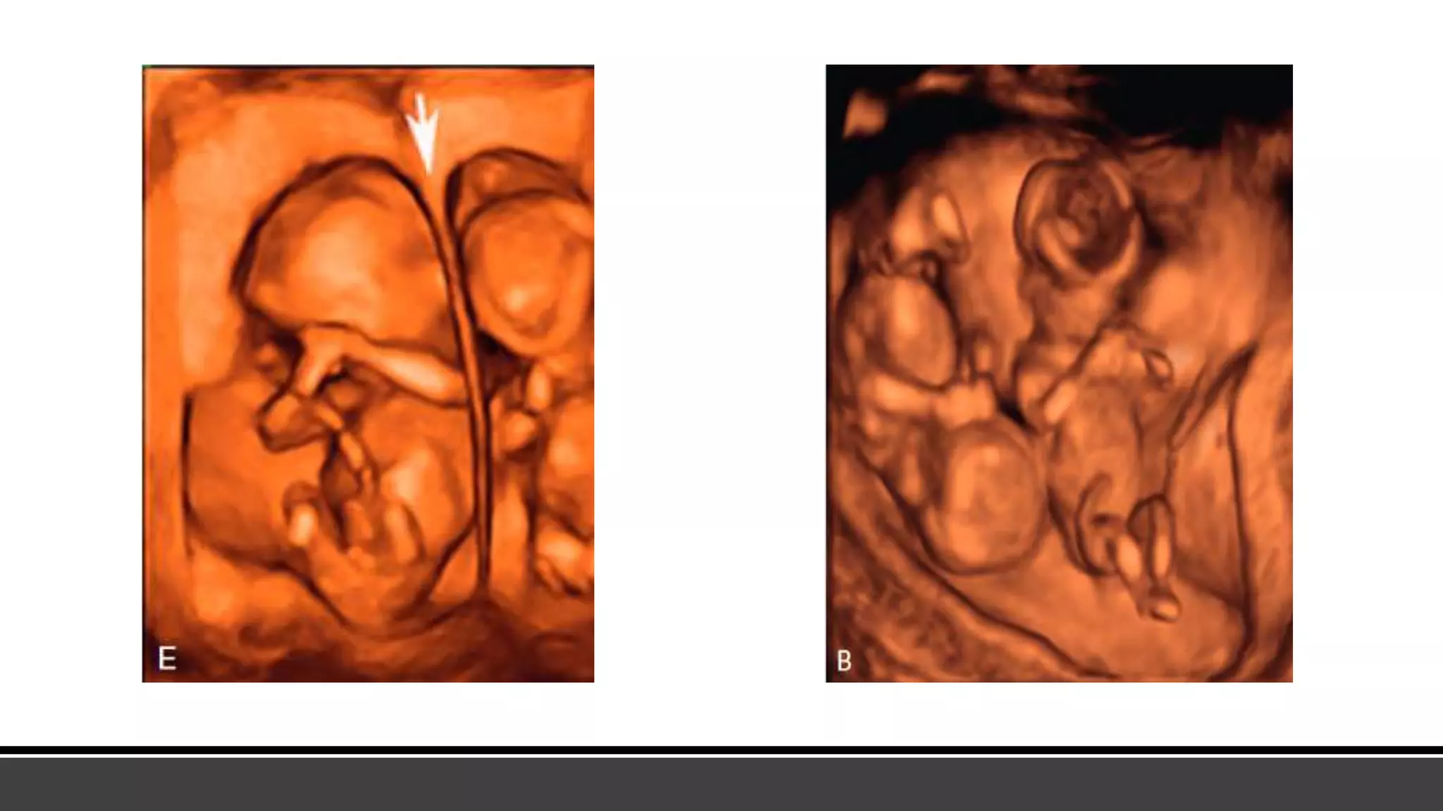 Multifetal pregnancy RADIOLOGY | PPTX