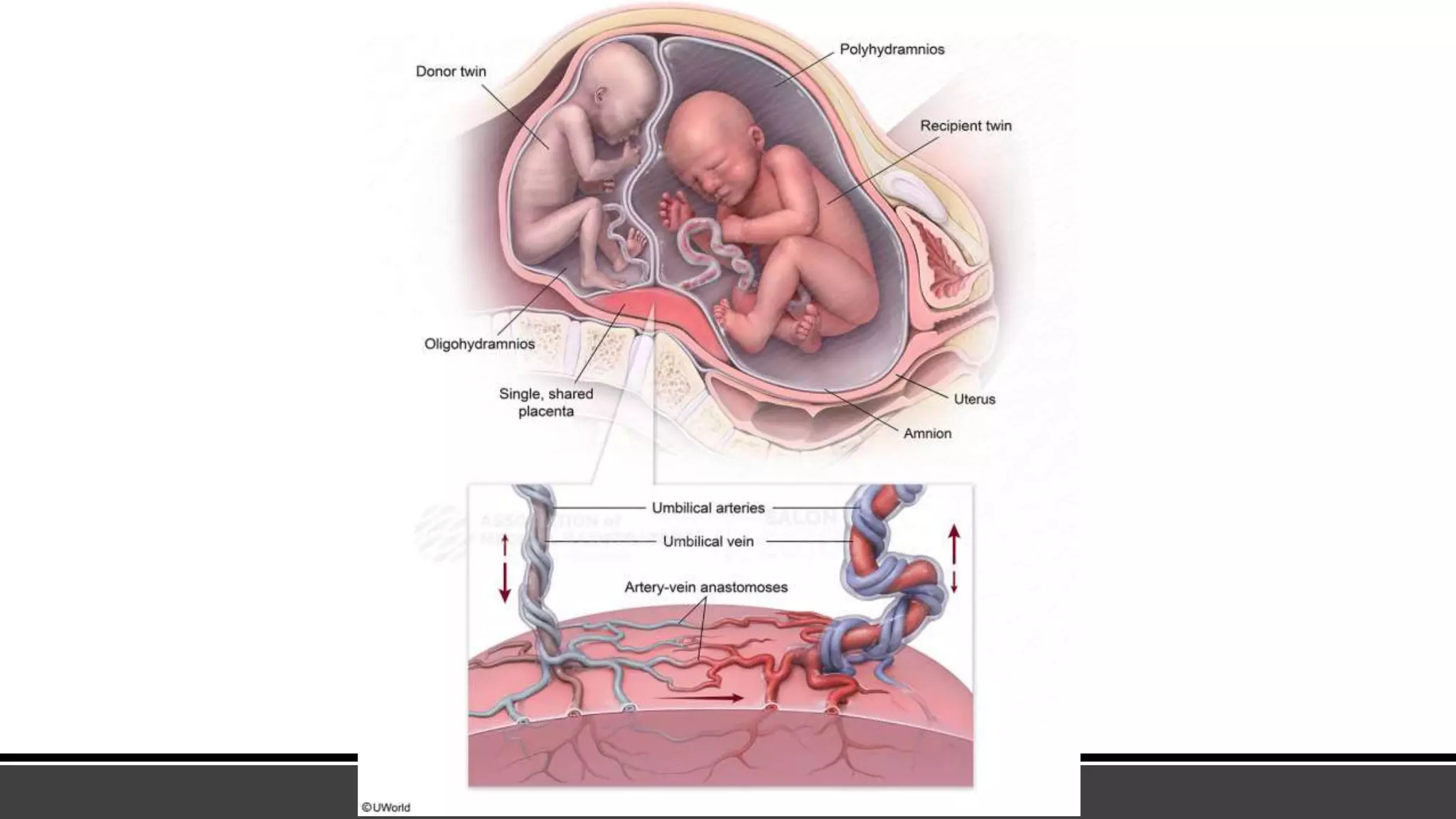 Multifetal pregnancy RADIOLOGY | PPTX