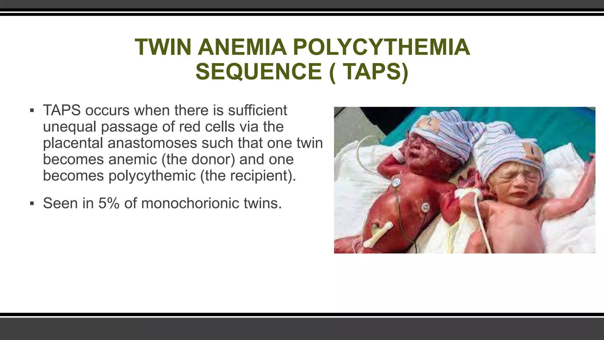 Multifetal pregnancy RADIOLOGY | PPTX