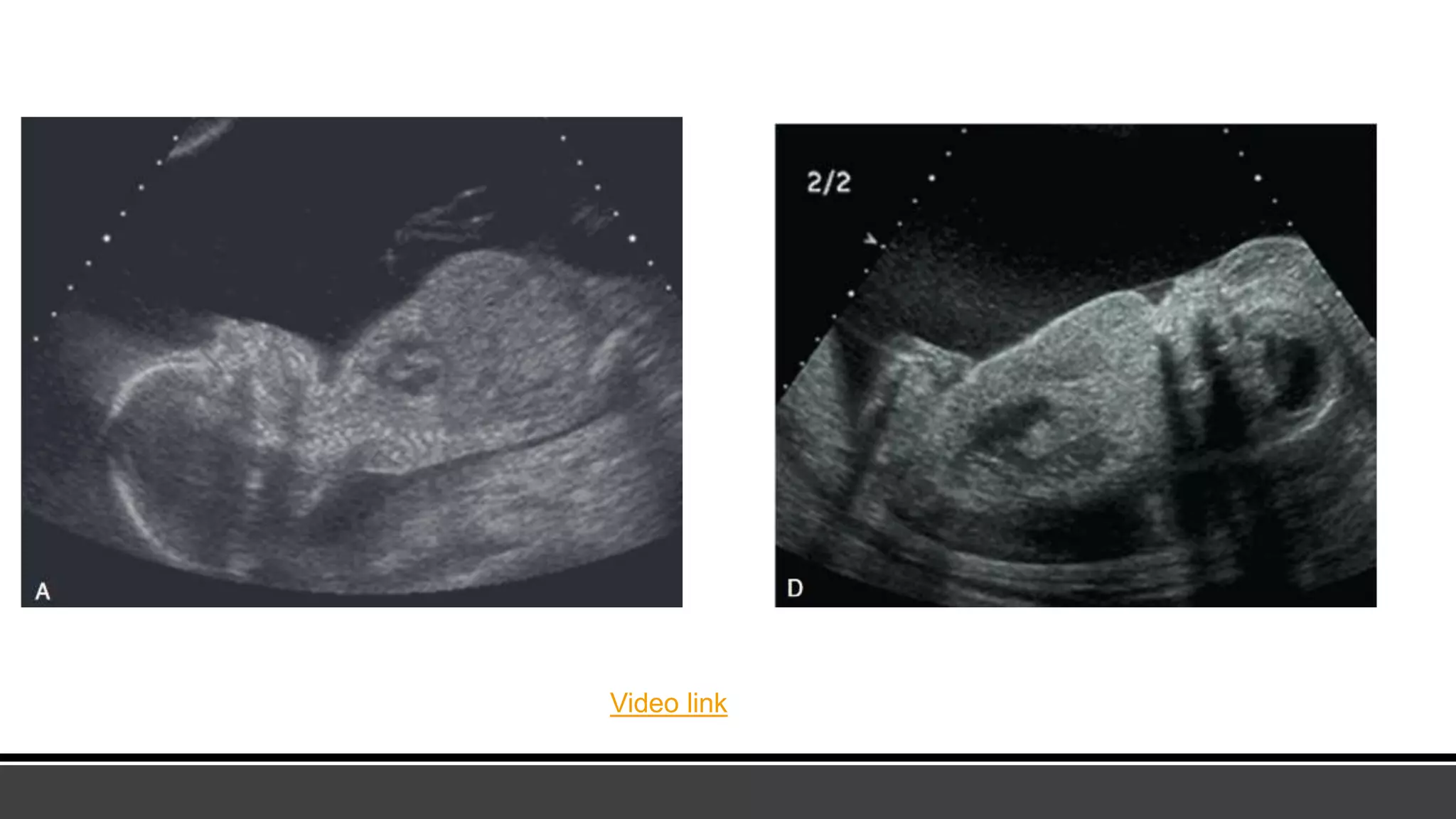 Multifetal pregnancy RADIOLOGY | PPTX