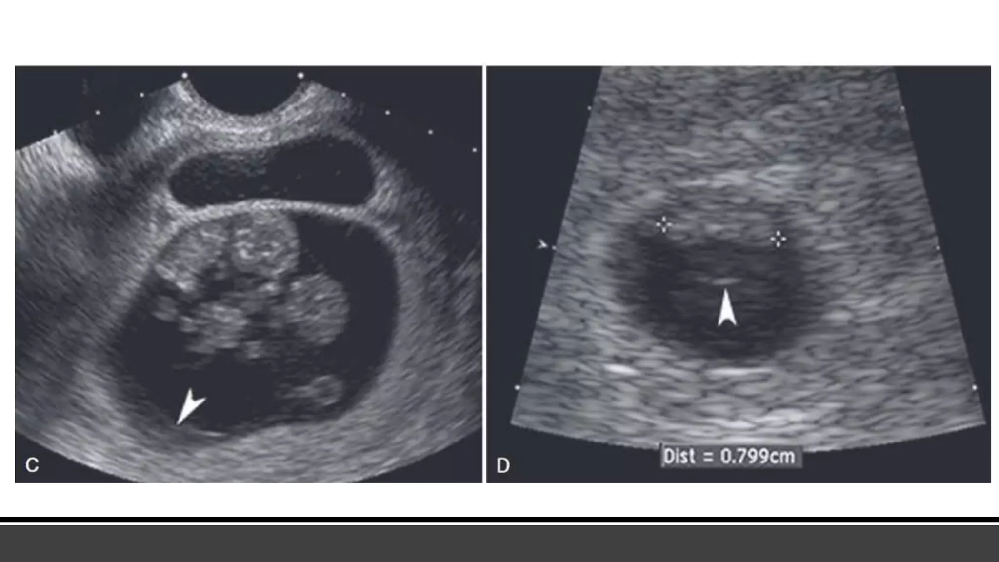 Multifetal pregnancy RADIOLOGY | PPTX