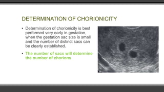 Multifetal pregnancy RADIOLOGY | PPTX