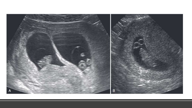 Multifetal pregnancy RADIOLOGY | PPTX