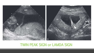 Twin Peaks Sign Ultrasound