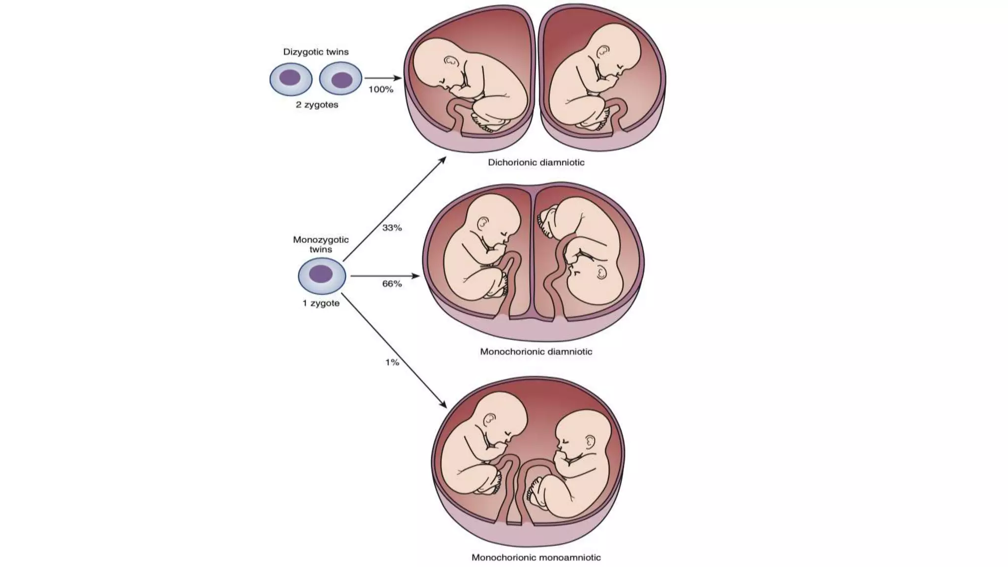 Multifetal Pregnancy.pptx