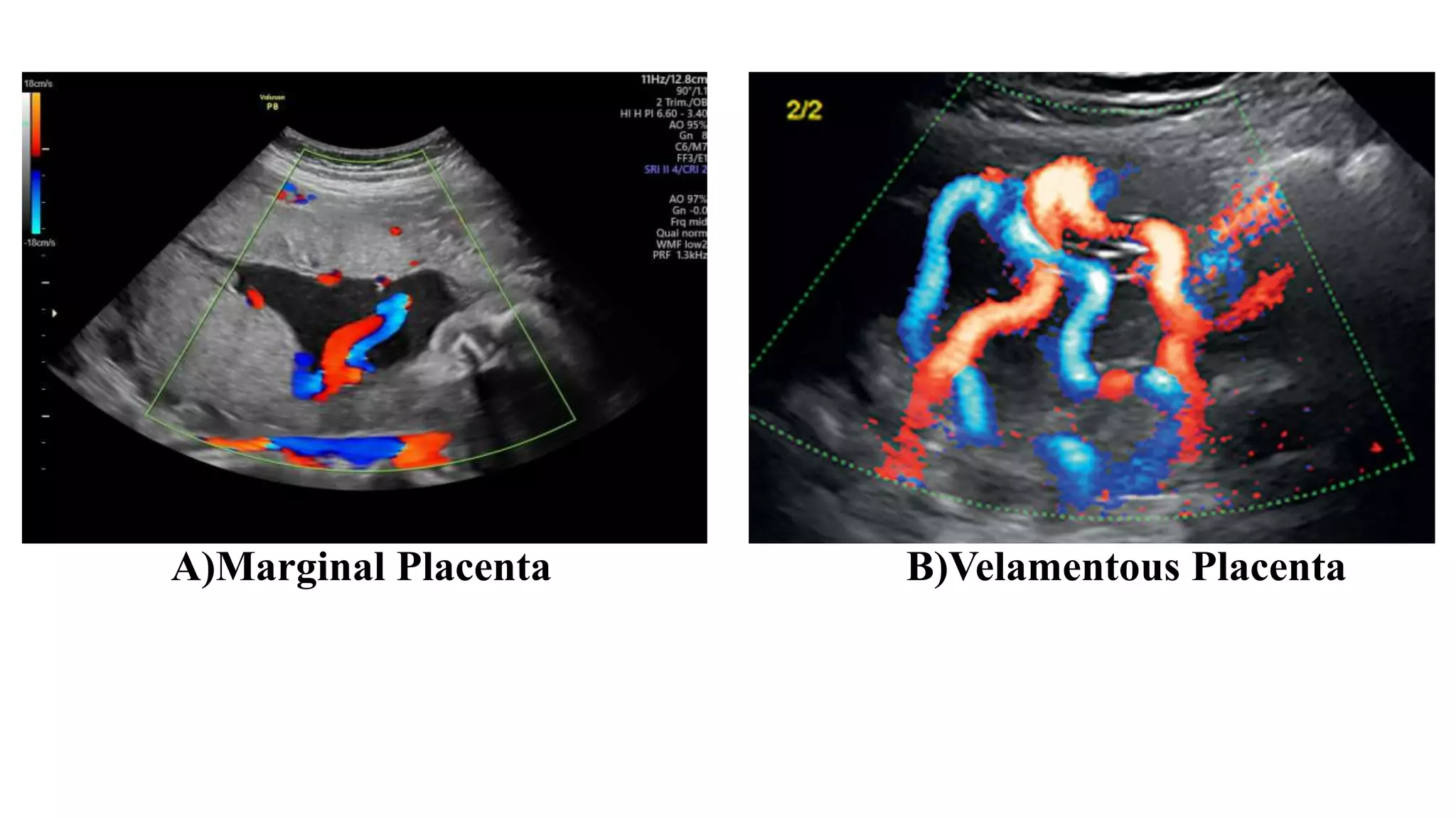 Multifetal Pregnancy.pptx