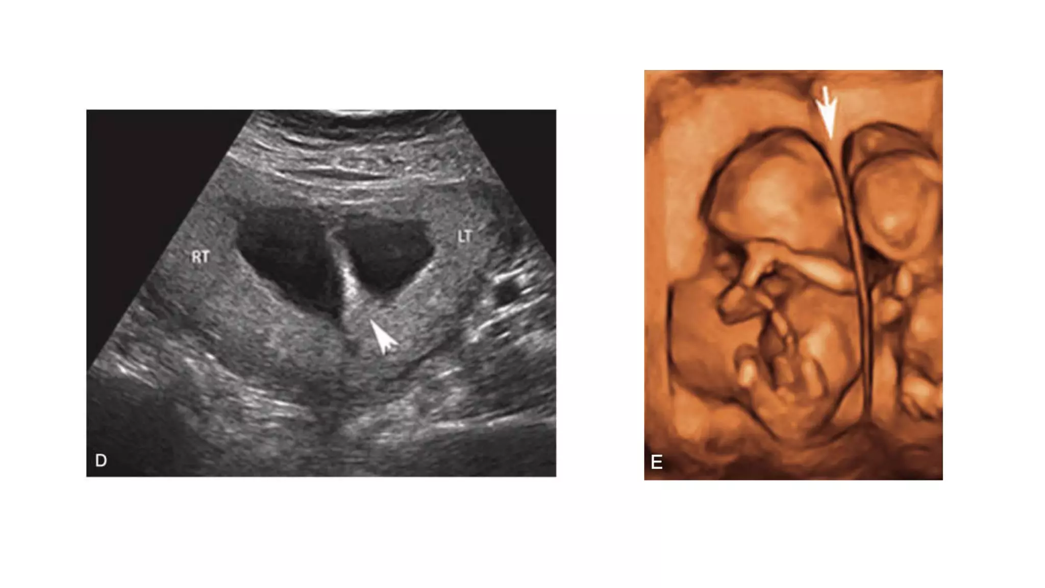 Multifetal Pregnancy.pptx