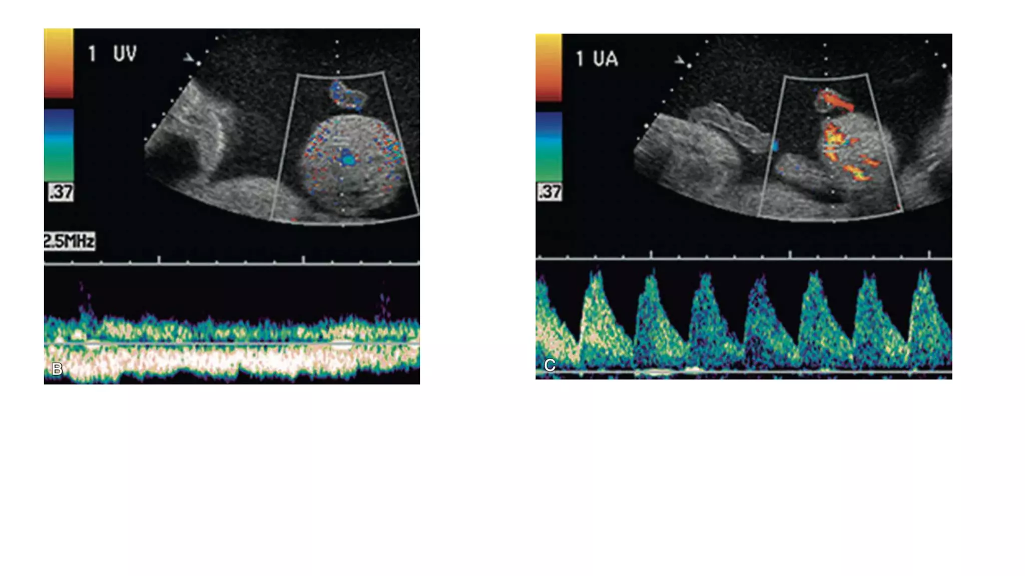 Multifetal Pregnancy.pptx
