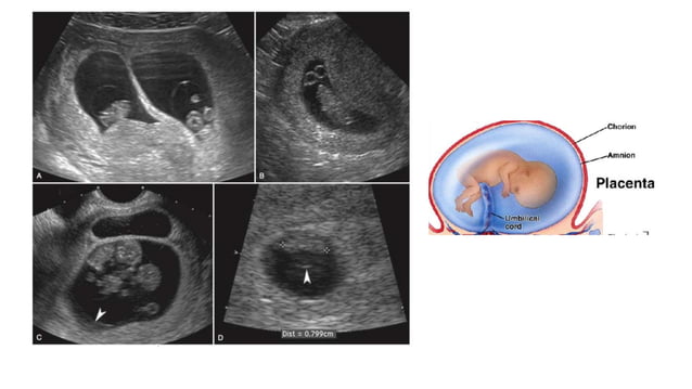 Multifetal Pregnancy.pptx