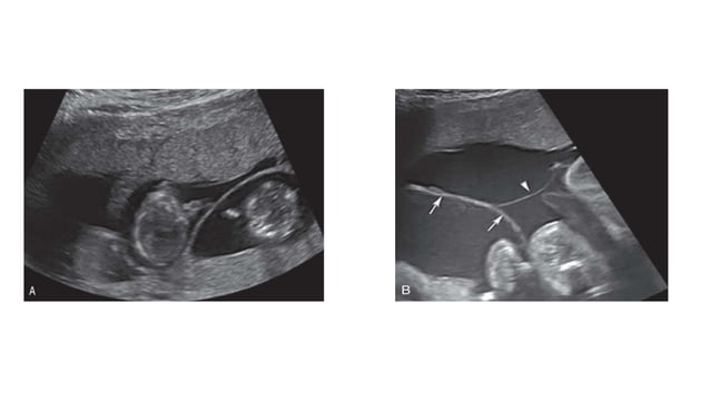 Multifetal Pregnancy.pptx