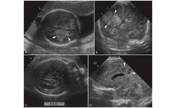 Multifetal Pregnancy.pptx