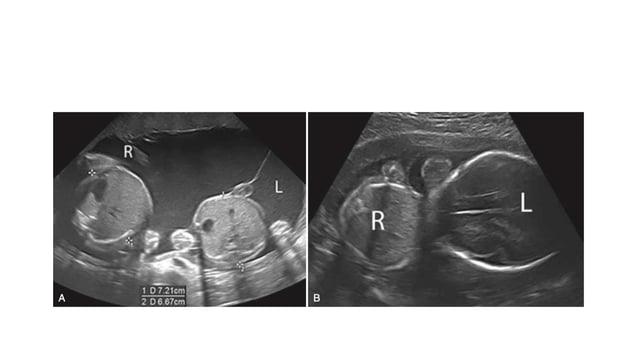 Multifetal Pregnancy.pptx