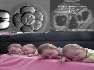 Multifetal pregnancy fetal reduction | PPTX