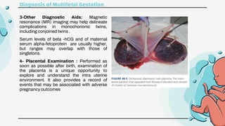 Complications of Multiple Pregnancy .pptx
