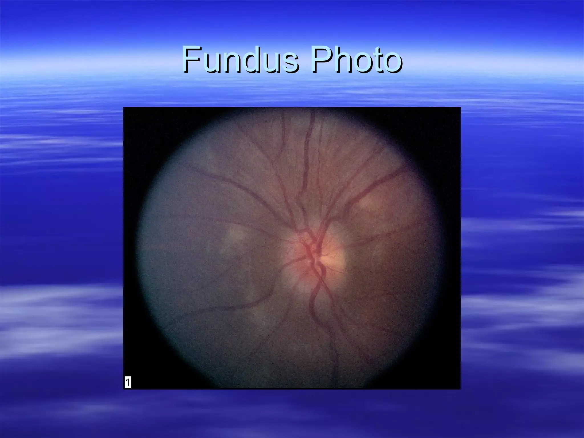 Multifocal Choroiditis | PPT