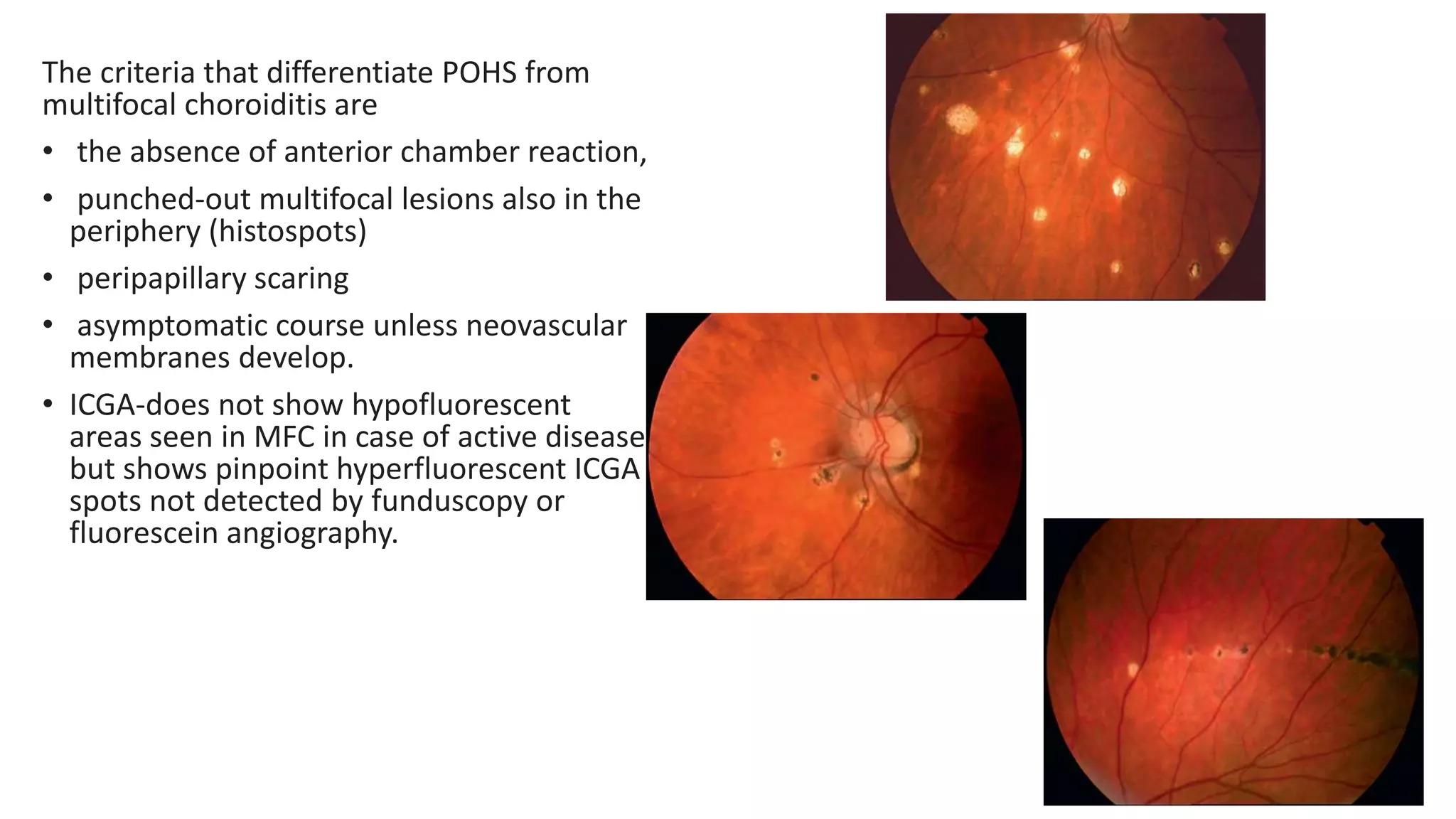 Multifocal choroiditis | PPTX