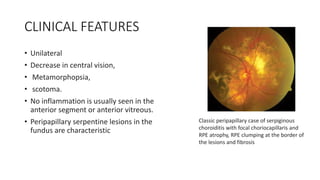 Multifocal choroiditis | PPTX