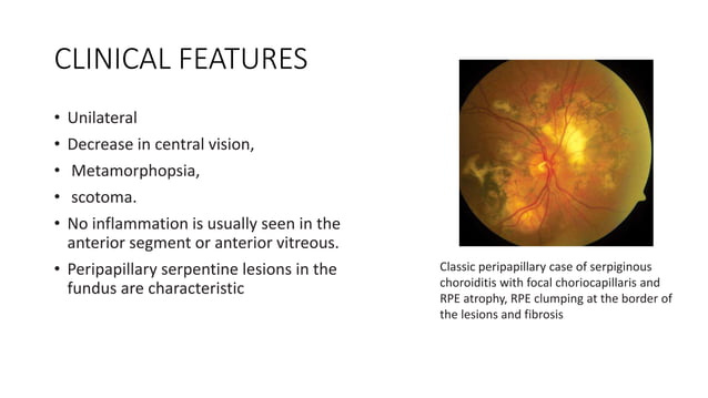 Multifocal choroiditis | PPTX