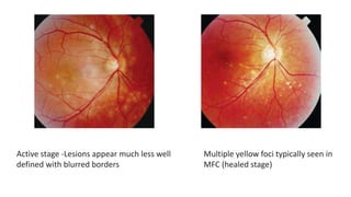 Multifocal choroiditis | PPTX