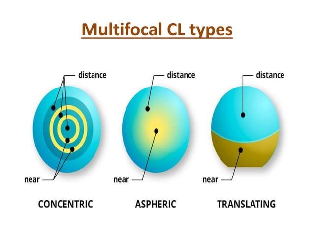 Multifocal contact lenses | PPTX