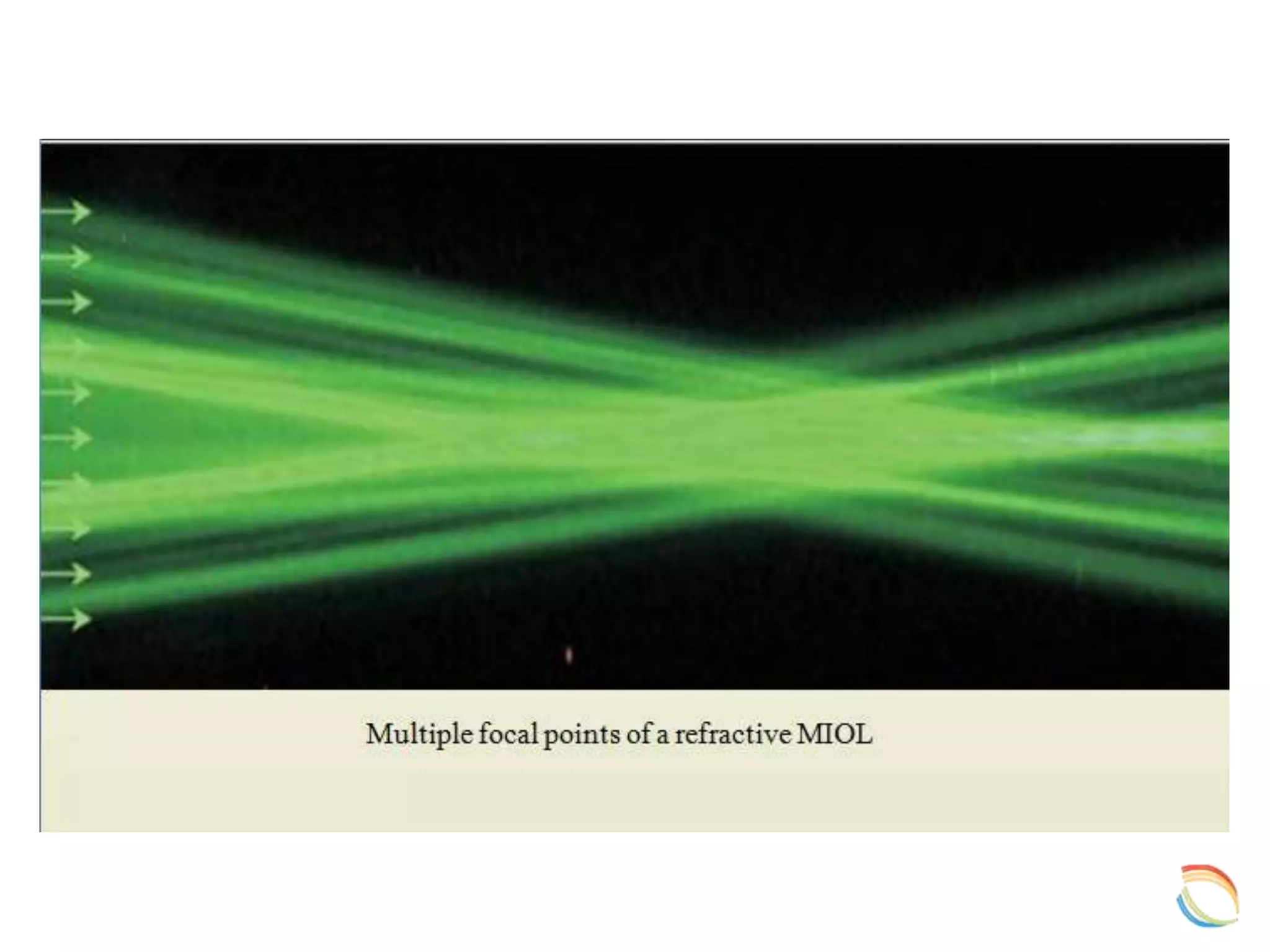 Multifocal IOL | PPTX