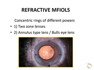 Multifocal IOL | PPTX