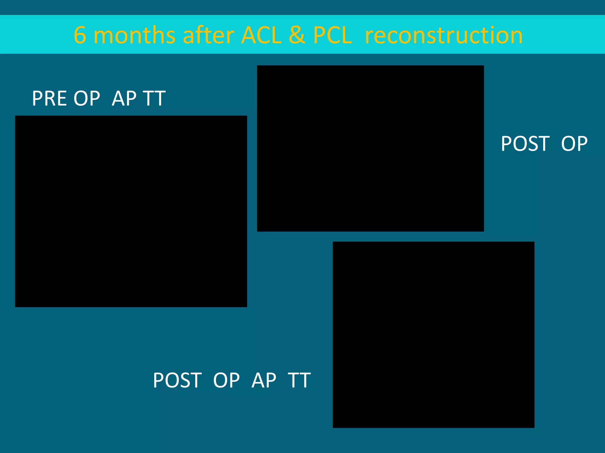 Multiligament Injury of Knee and ACL & PCL Reconstruction | PPTX