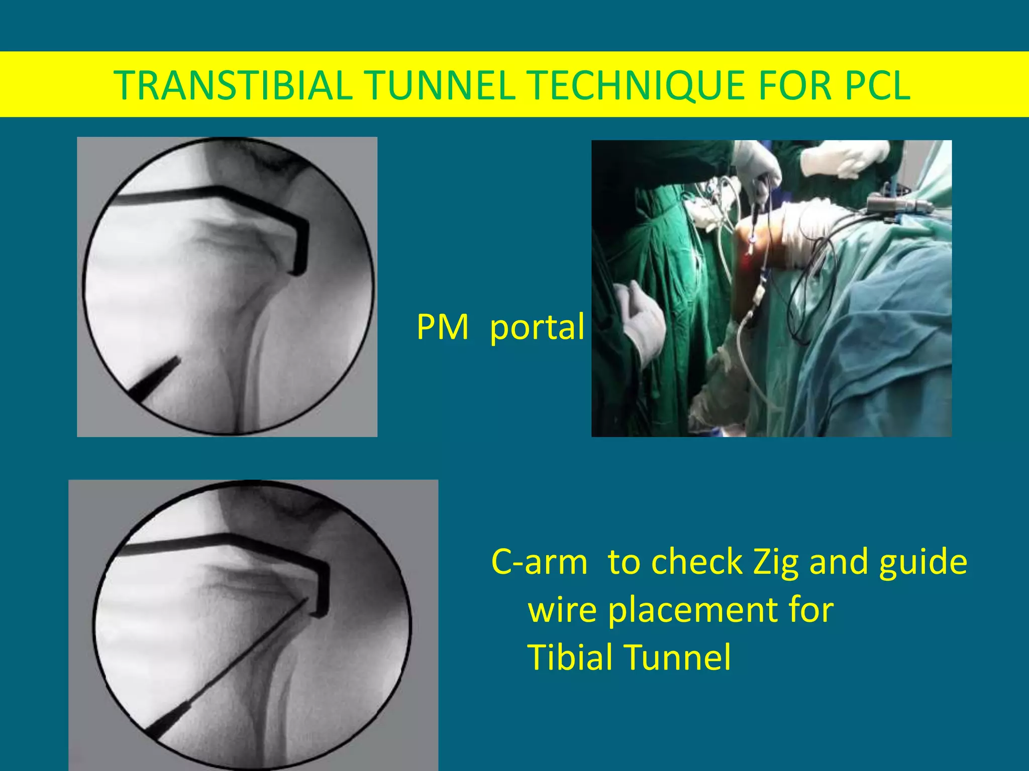 Multiligament Injury of Knee and ACL & PCL Reconstruction | PPTX