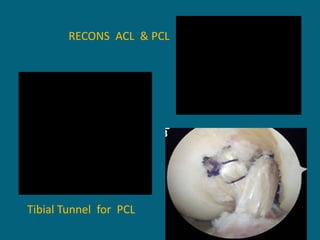 Multiligament Injury of Knee and ACL & PCL Reconstruction | PPTX