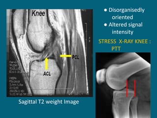 Multiligament Injury of Knee and ACL & PCL Reconstruction | PPTX