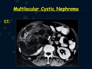 Multilocular cystic nephroma | PPT