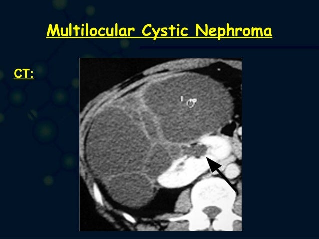 Multilocular cystic nephroma