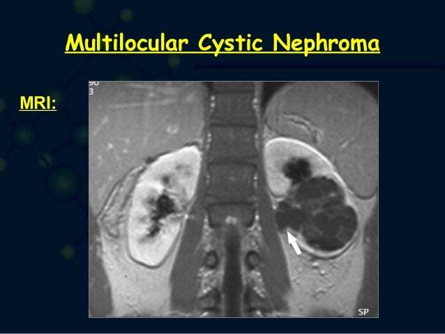 Multilocular cystic nephroma