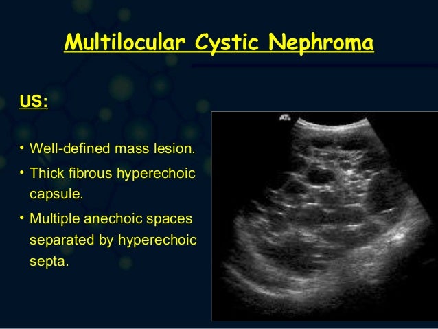 Multilocular cystic nephroma