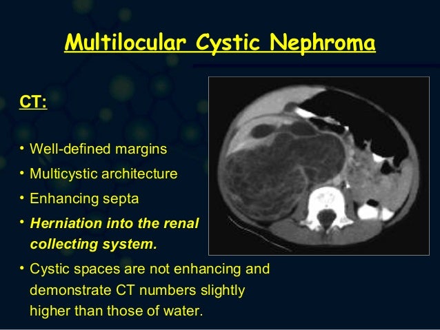 Multilocular cystic nephroma