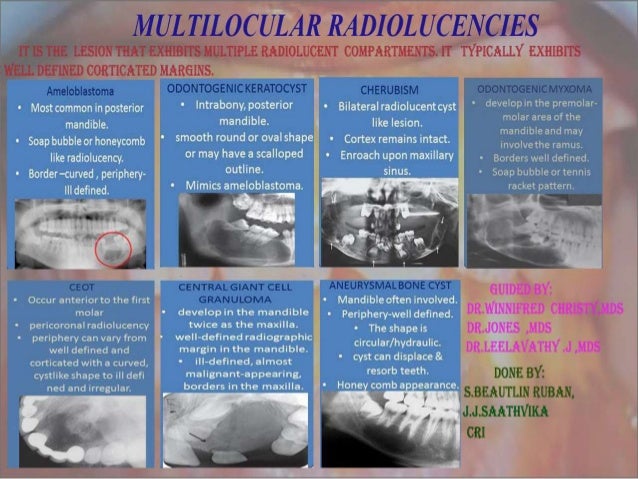 Multilocular radiolucencies