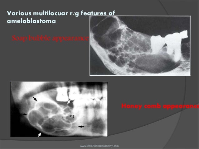 Multilocular radiolucencies /endodontic courses