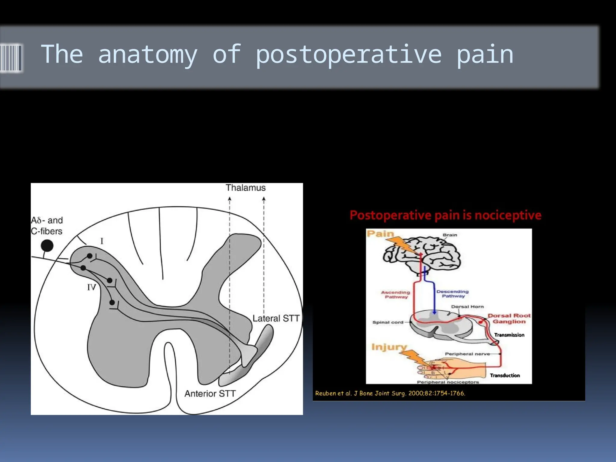 Multimodal approach in acute post operative pain.pptx