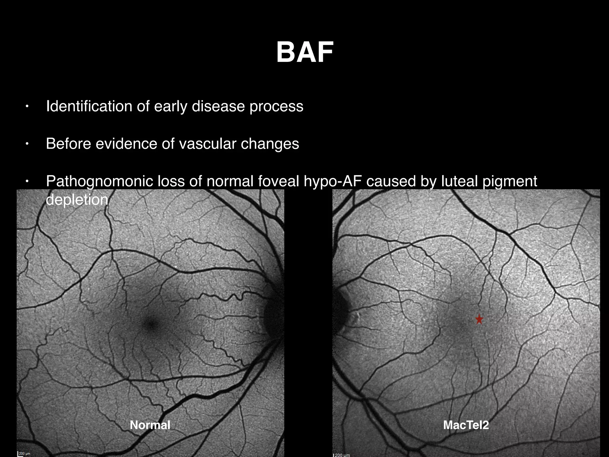 Multimodal imaging in MacTel-2 | PDF