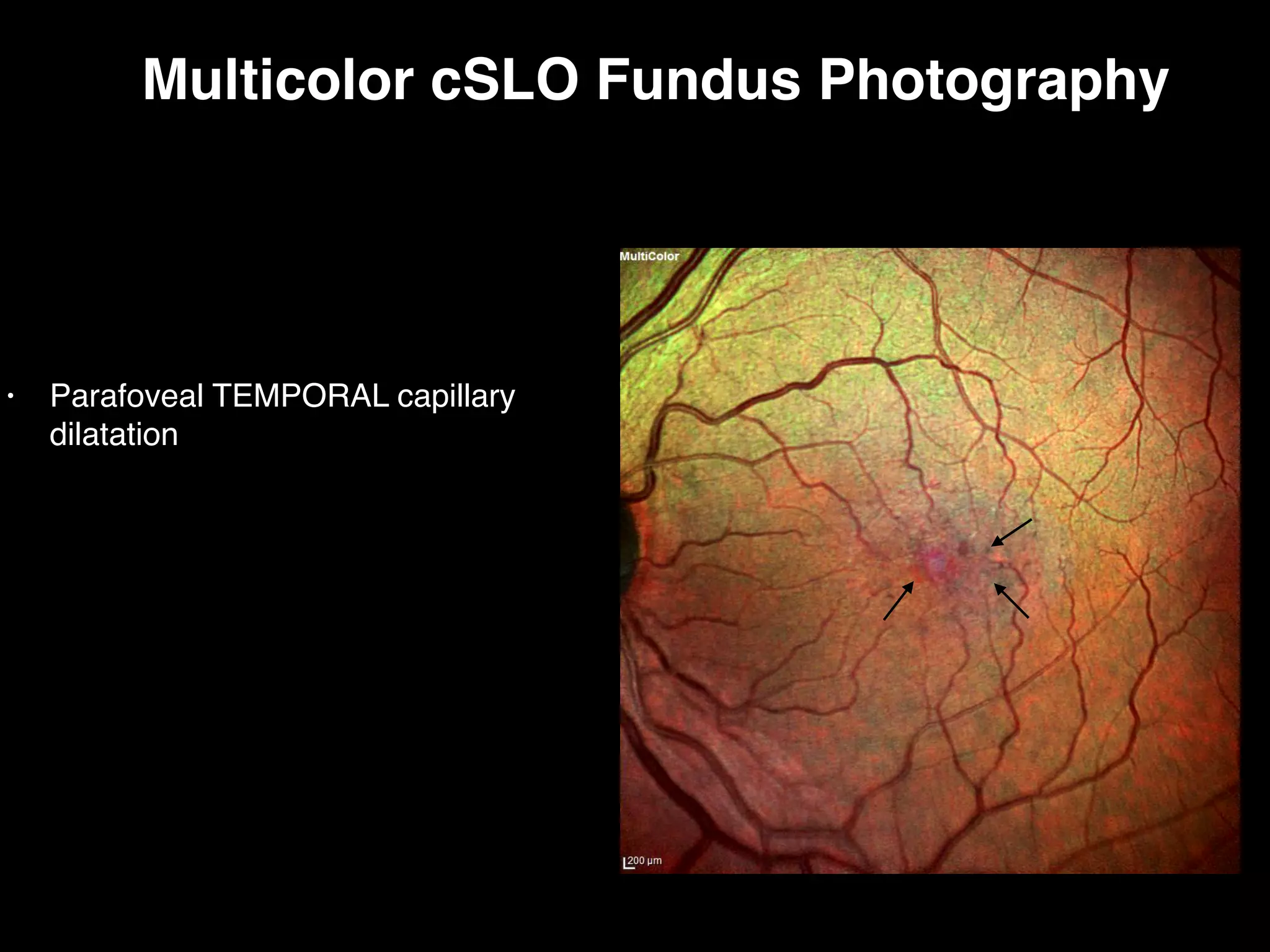 Multimodal imaging in MacTel-2 | PDF
