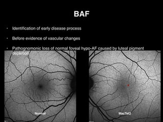 Multimodal imaging in MacTel-2 | PDF