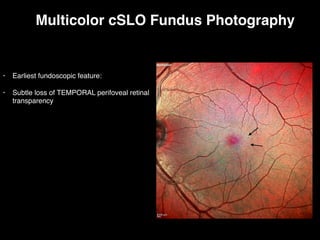 Multimodal imaging in MacTel-2 | PDF