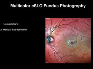 Multimodal imaging in MacTel-2 | PDF