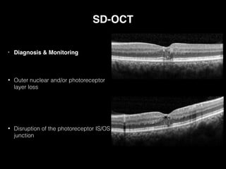 Multimodal imaging in MacTel-2 | PDF