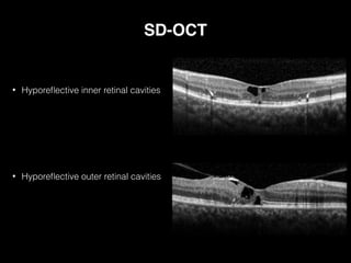 Multimodal imaging in MacTel-2 | PDF