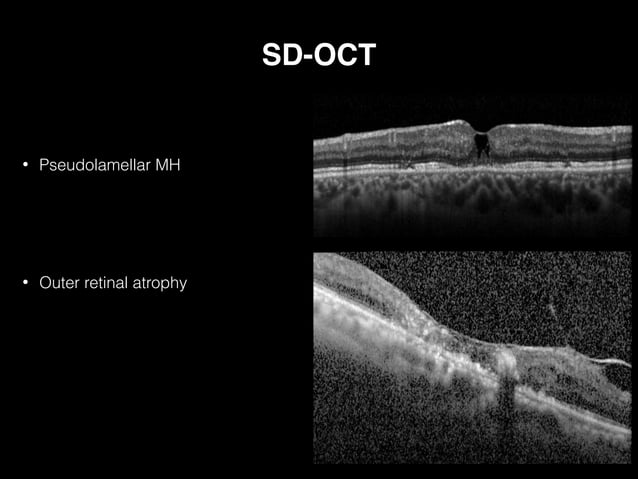 Multimodal imaging in MacTel-2 | PDF