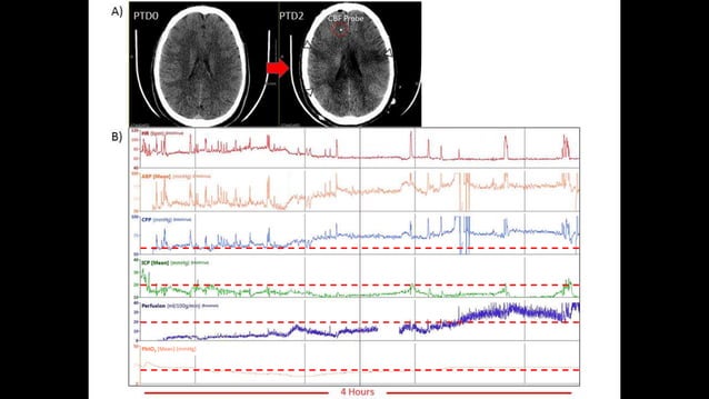 Multimodal monitoring | PPT