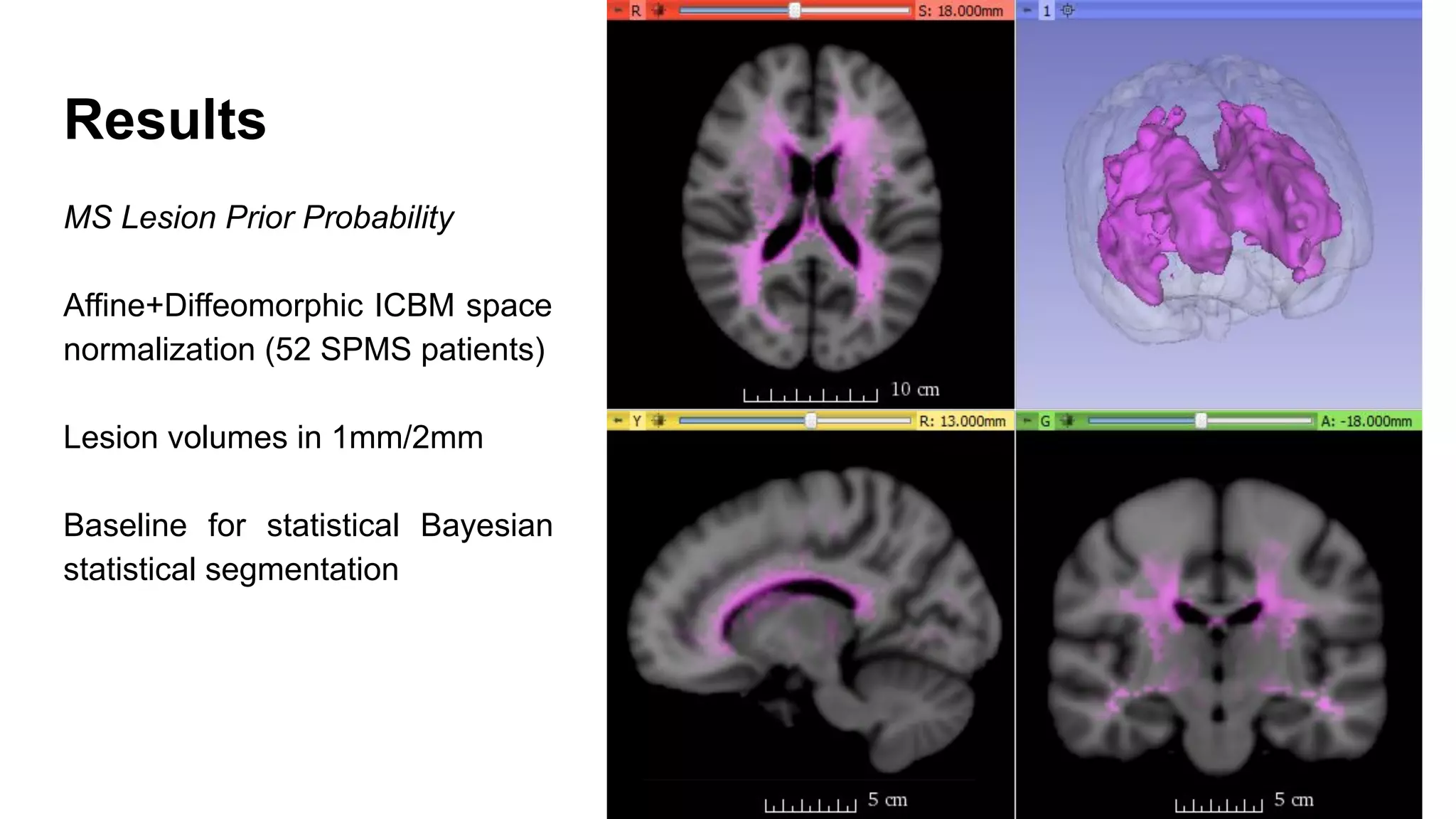 Multimodal MRI statistical segmentation of normal appearing white matter lesions in multiple ...